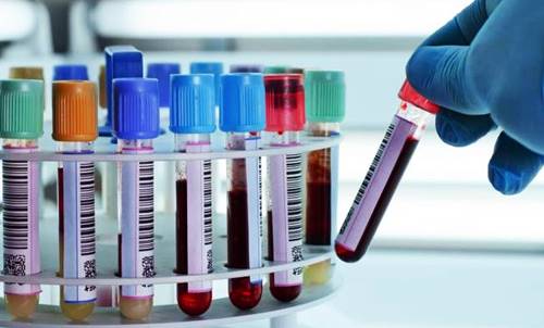 New blood test for brain injury diagnosis wins FDA approval - The ...